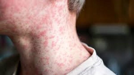 More Measles Cases Reported in PA | Lightner Communications LLC ...