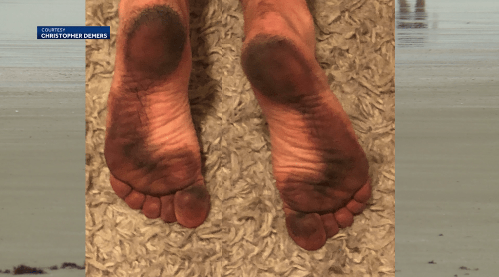 It's not algae: What is staining people's feet at some East Coast ...